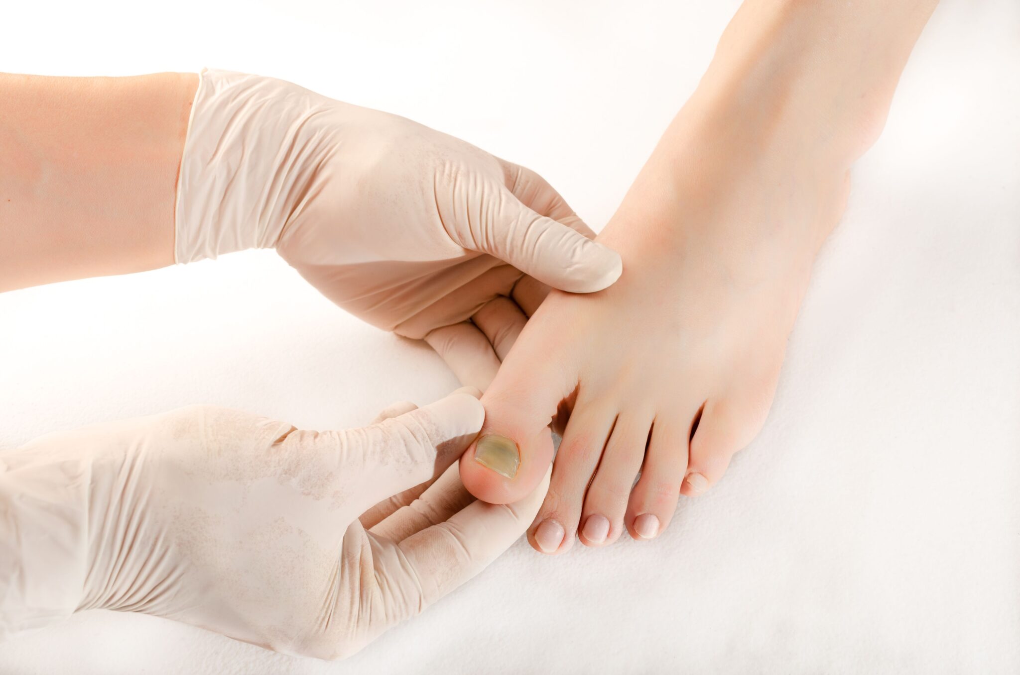 Identifying Nail Fungus Early: Recognizing Signs and Symptoms for ...